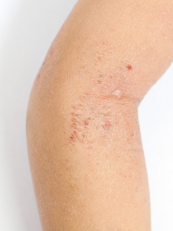 Kenali Eksim dan Cara Penanganannya! - Serenitree Indonesia